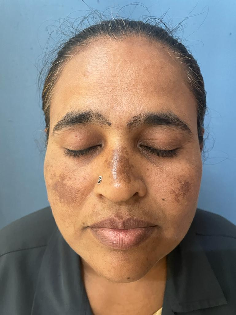 Melasma | Pigmentation – Dr. Mubashir Mushtaq Daha